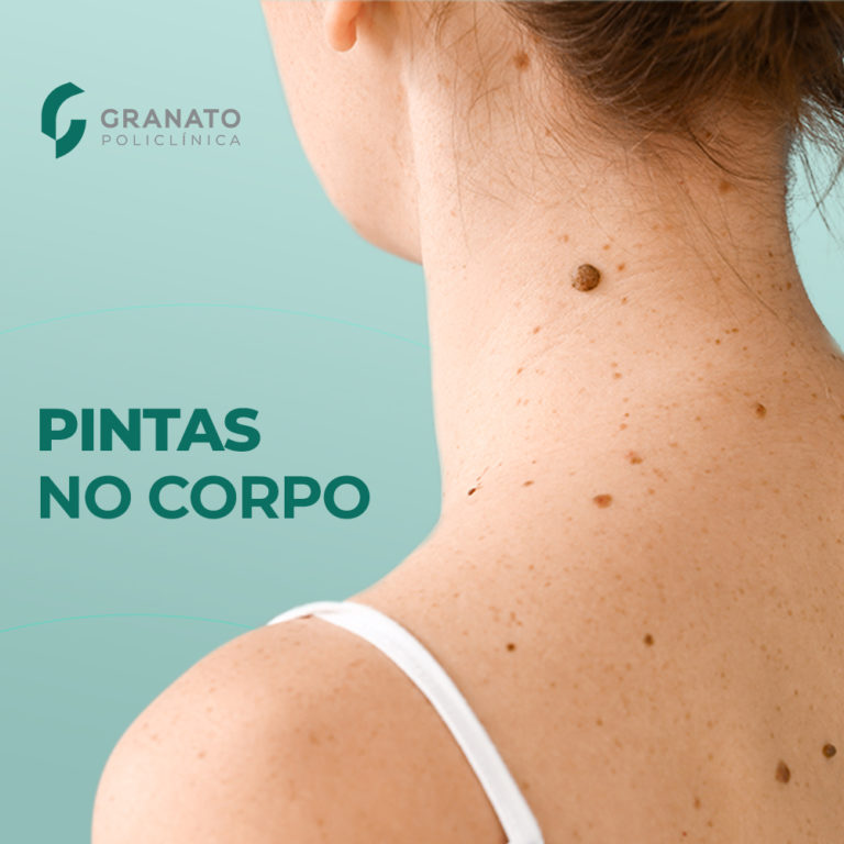 Como saber se uma pinta indica câncer? - Policlínica Granato