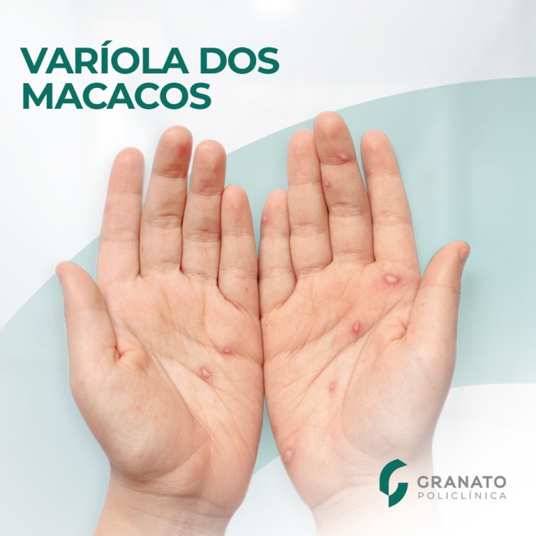 Varíola dos Macacos: tudo o que você precisa saber sobre a doença ...